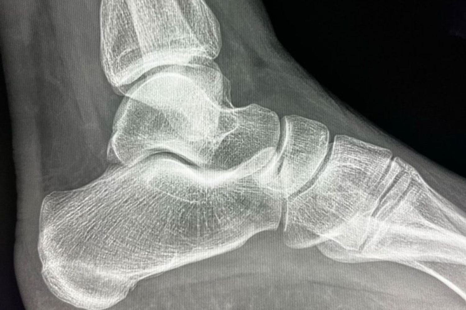 45 YEAR OLD FEMALE WITH ANKLE PAIN. TEST YOUR DIAGNOSTIC SKILL ...