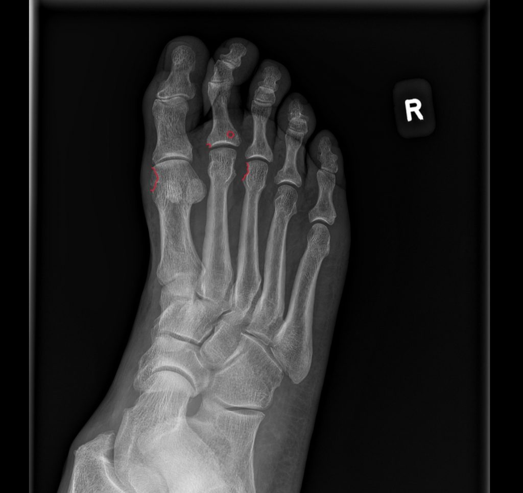 A DACBR's Guide to Gout Imaging & Radiology Reports - Kinetic Radiology