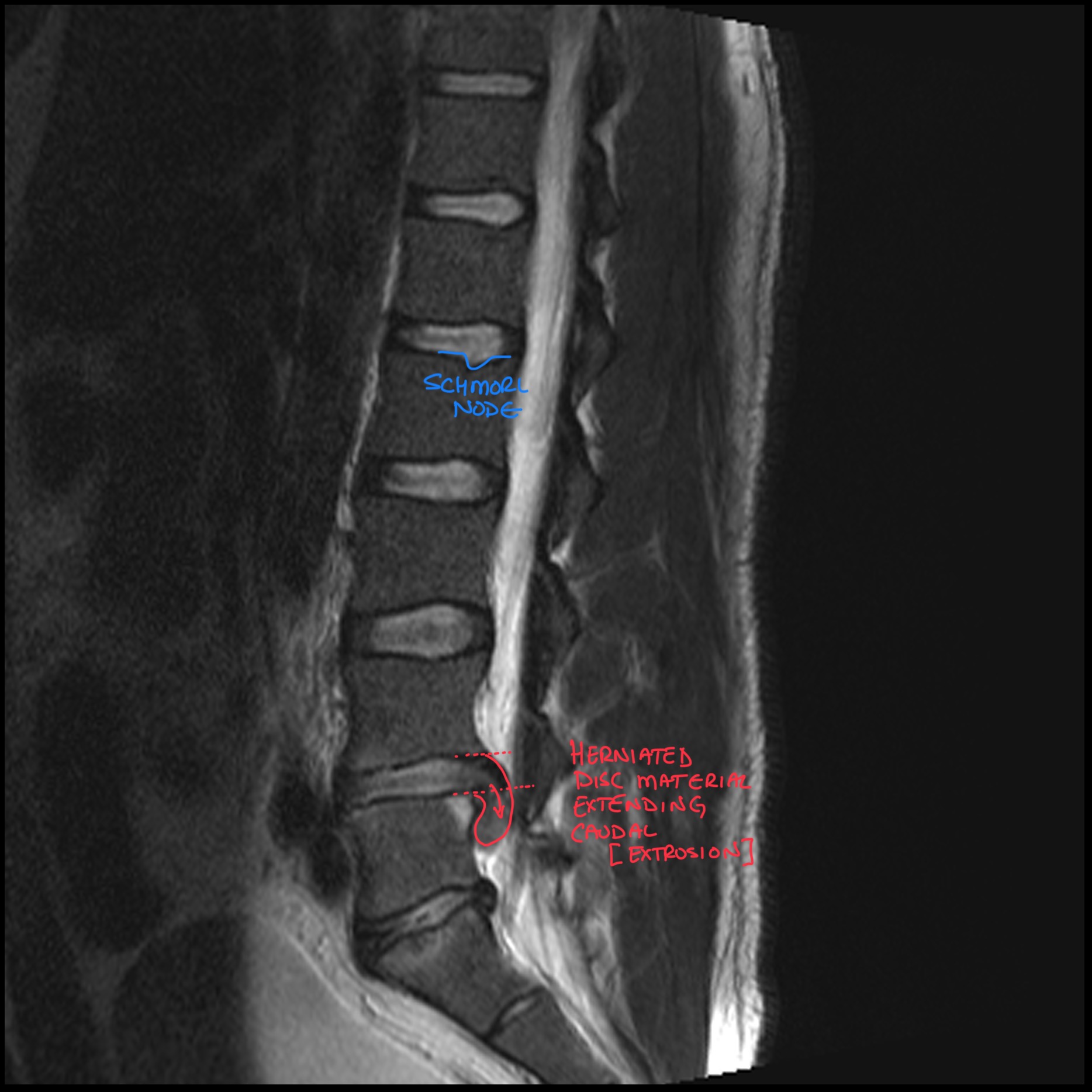Professional Imaging Consultants (DACBR) Reporting on a Lumbar Disc ...