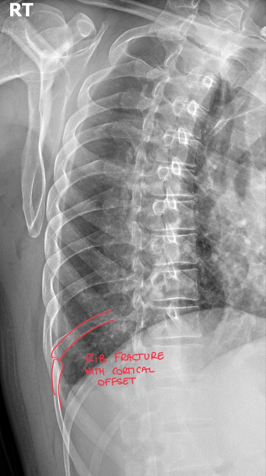 Diagnostic Imaging Consultants Radiographic Guide to Rib Fractures ...