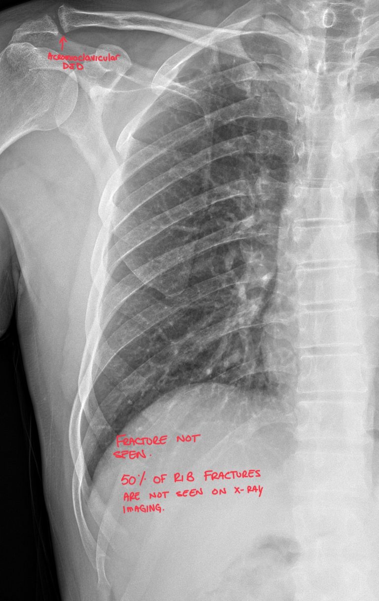 Diagnostic Imaging Consultants Radiographic Guide to Rib Fractures ...