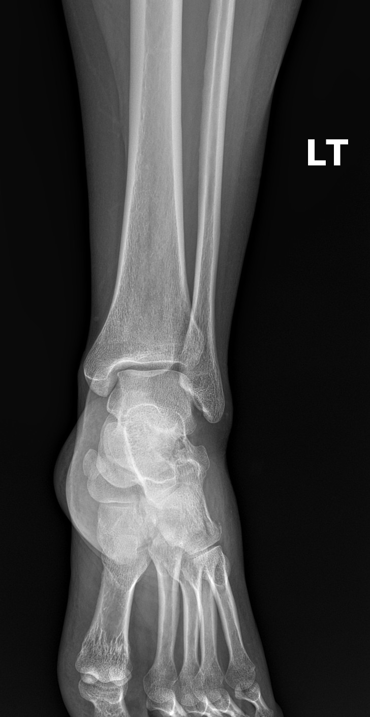 DACBR Reports on an Avulsion Fracture of the Cuboid - Diagnostic ...