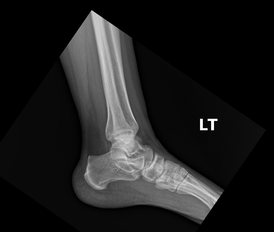 DACBR Reports on an Avulsion Fracture of the Cuboid - Diagnostic ...