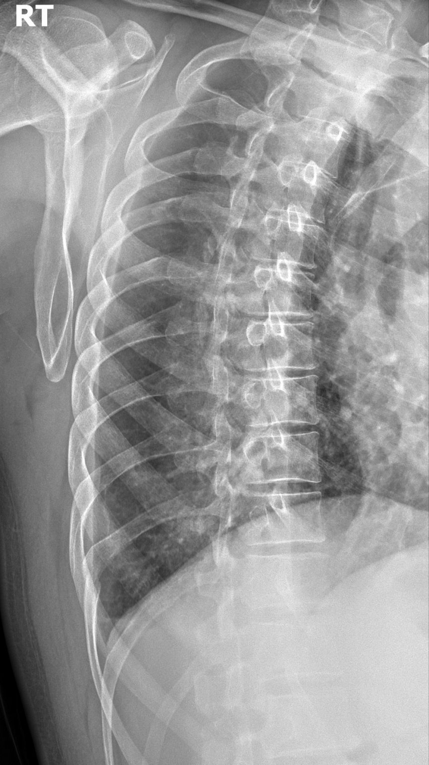 Diagnostic Imaging Consultants Radiographic Guide to Rib Fractures ...