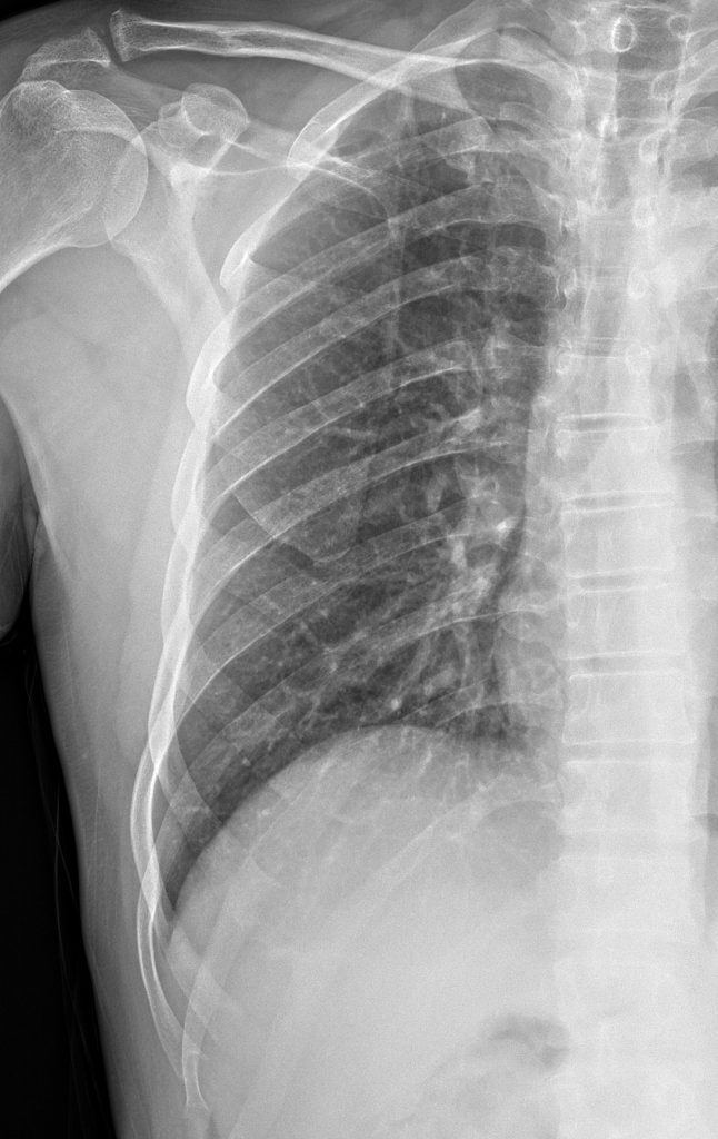Diagnostic Imaging Consultants Radiographic Guide to Rib Fractures ...