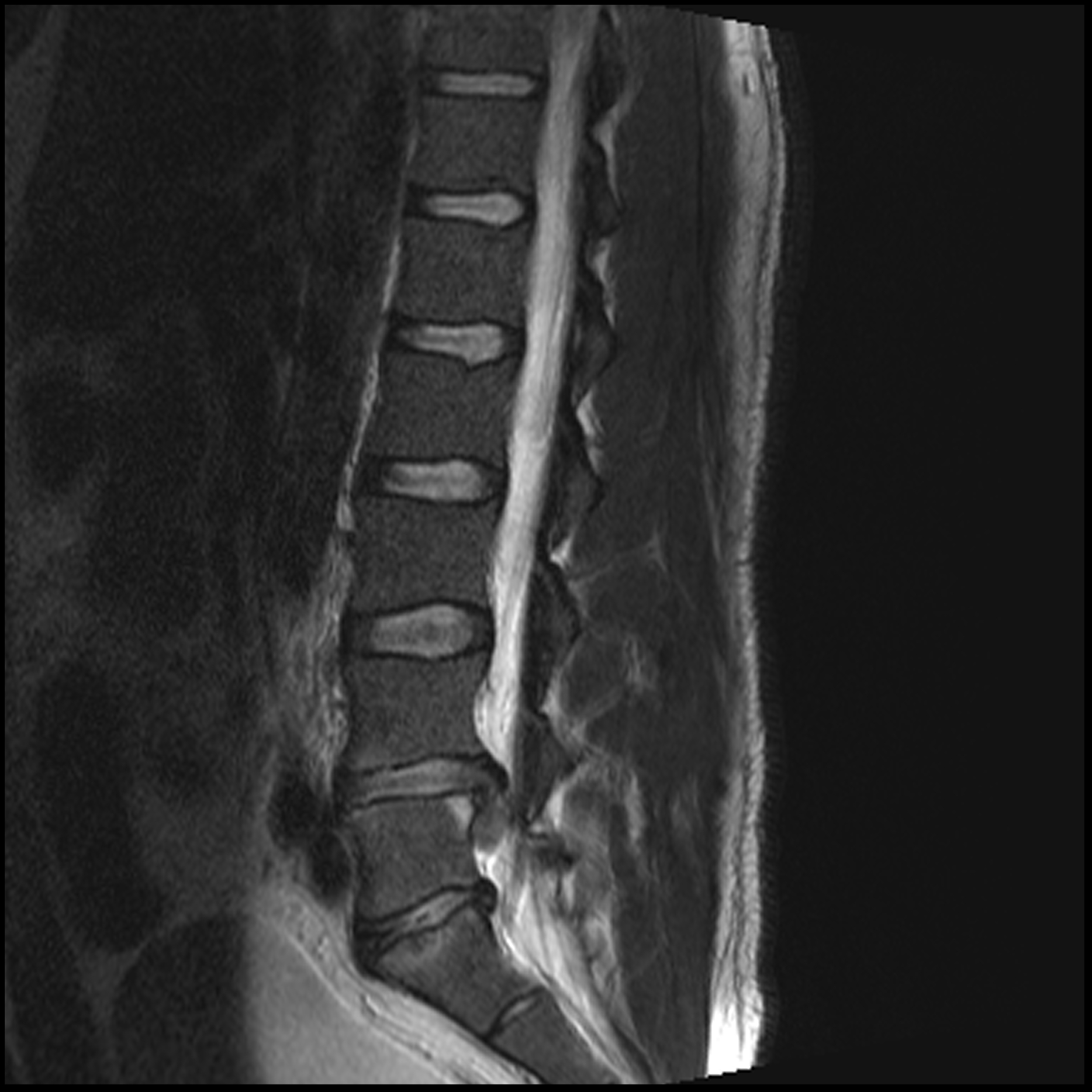 Professional Imaging Consultants (DACBR) Reporting on a Lumbar Disc ...