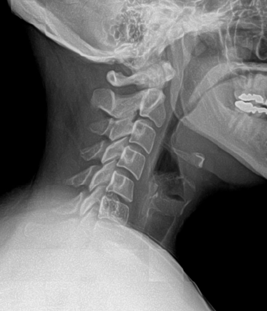 DACBR Finds an Incidental Hemangioma - Kinetic Radiology