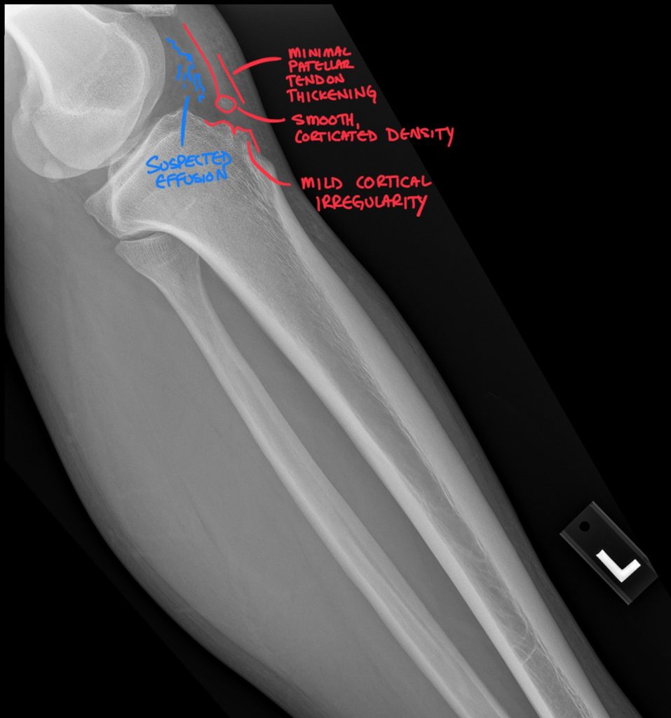 Osgood- Schlatter Disease - Everything a Chiropractor Should Know, but ...