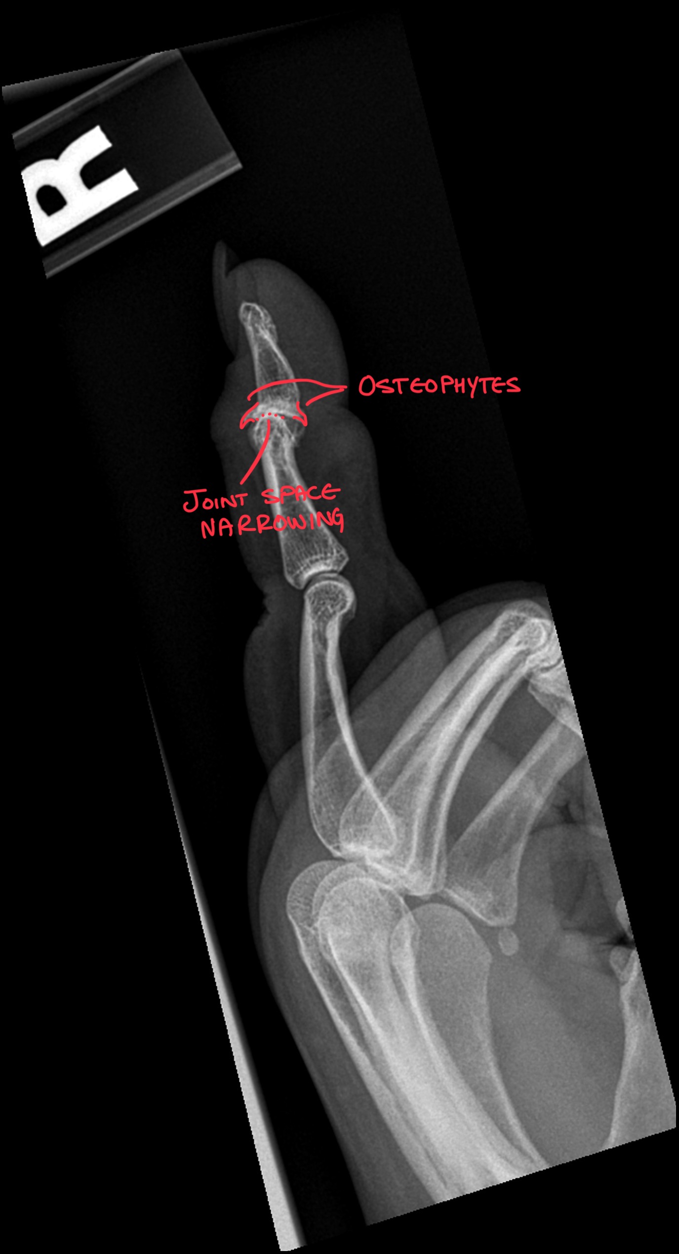 Diagnostic Imaging Consultants Second Opinion on Erosive Osteoarthritis ...