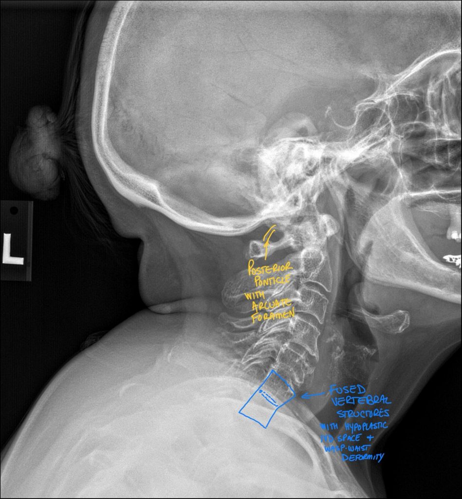Congenital Block Vertebra: A radiologist (DACBR) perspective - Kinetic ...
