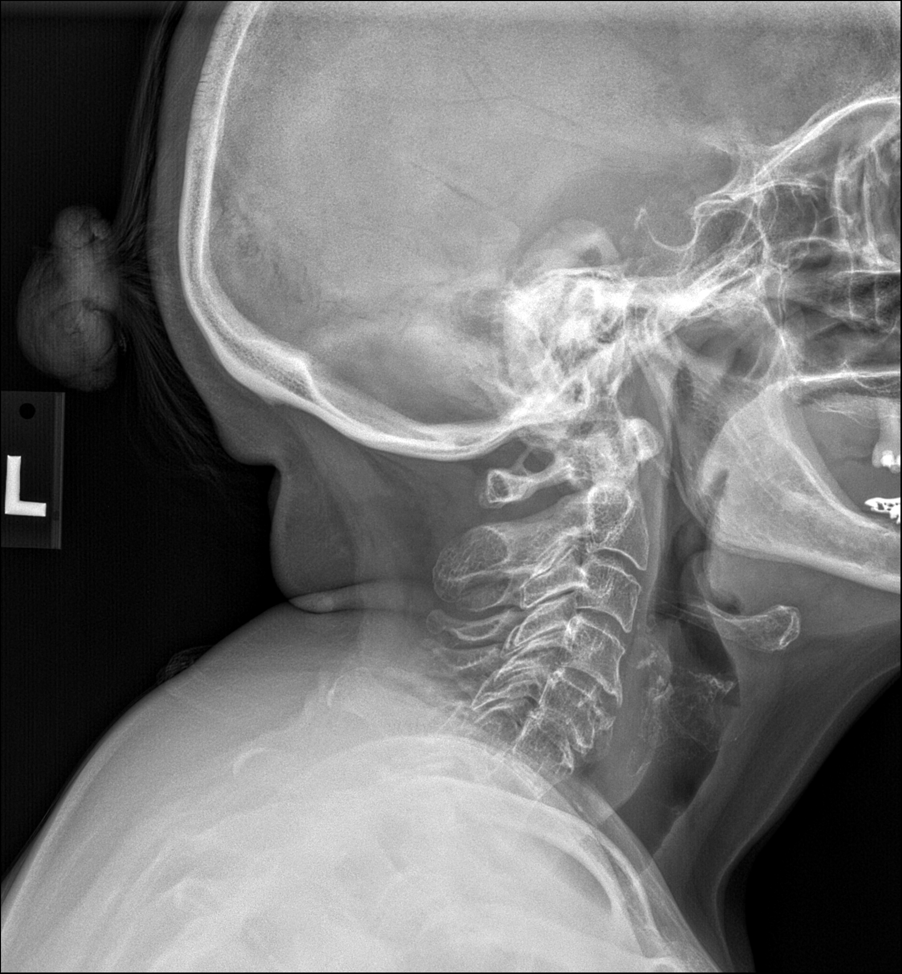 Congenital Block Vertebra: A radiologist (DACBR) perspective - Kinetic ...