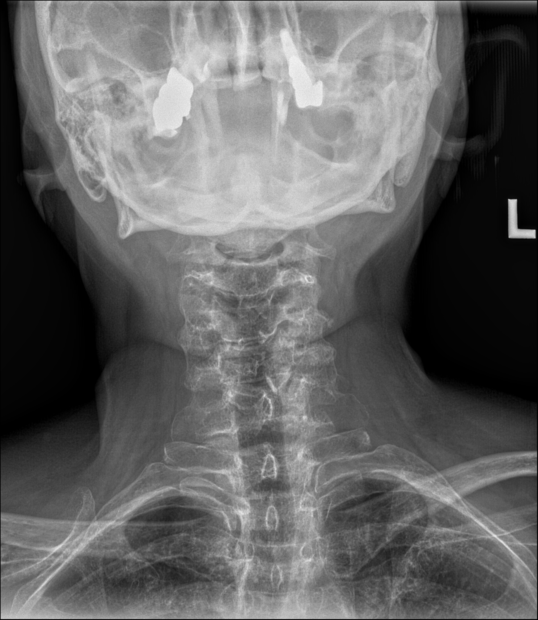 Congenital Block Vertebra: A radiologist (DACBR) perspective - Kinetic ...