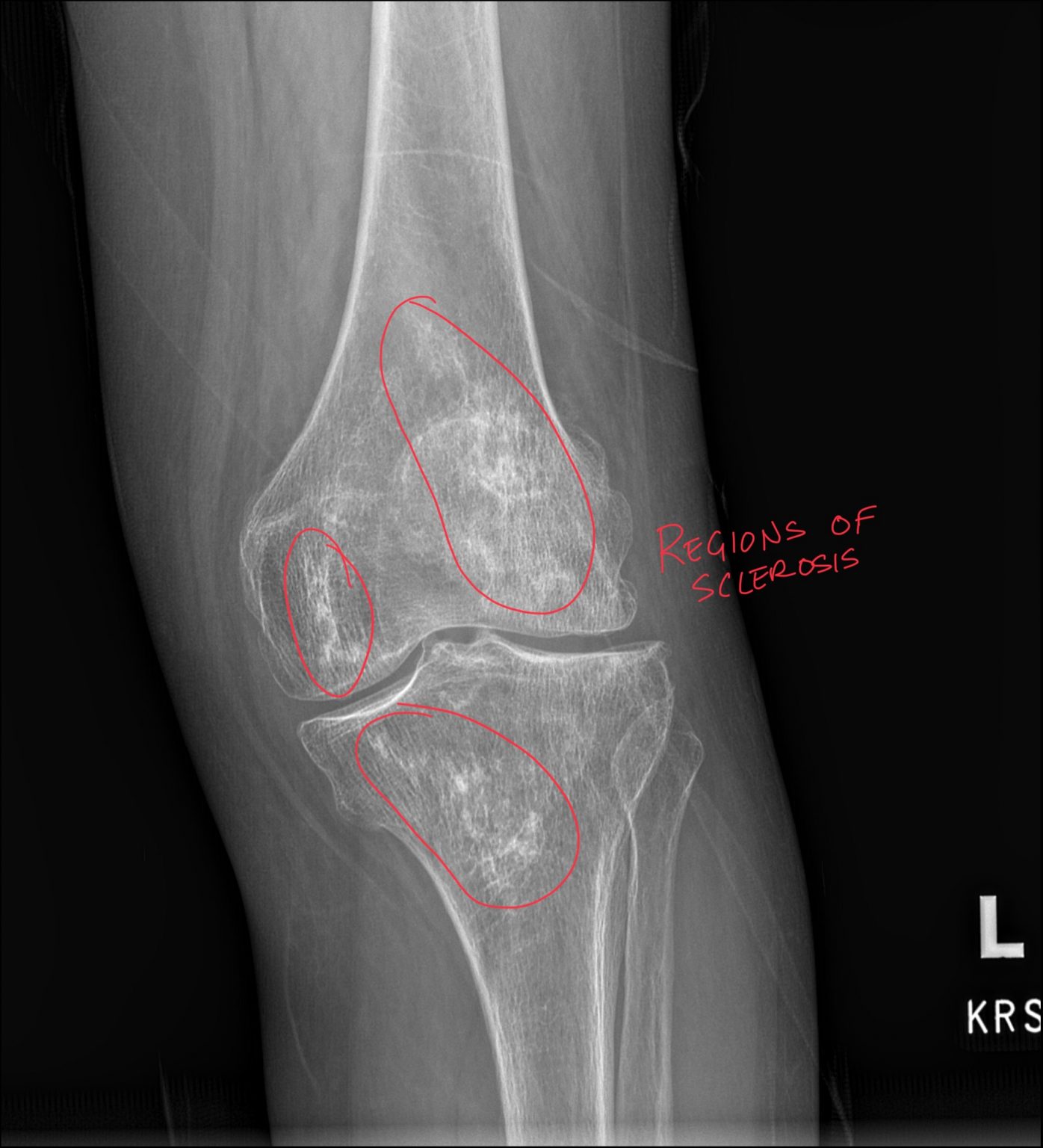 Radiology Reports on Bone Infarctions: A Comprehensive Guide to ...