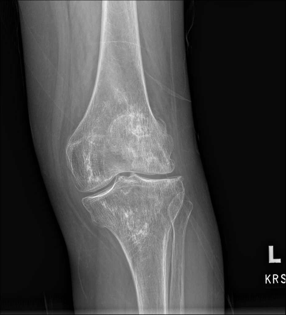 Radiology Reports on Bone Infarctions: A Comprehensive Guide to ...